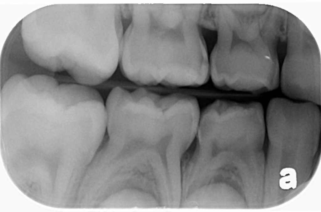 Why do we take x-rays? - Norwest Paediatric Dentistry