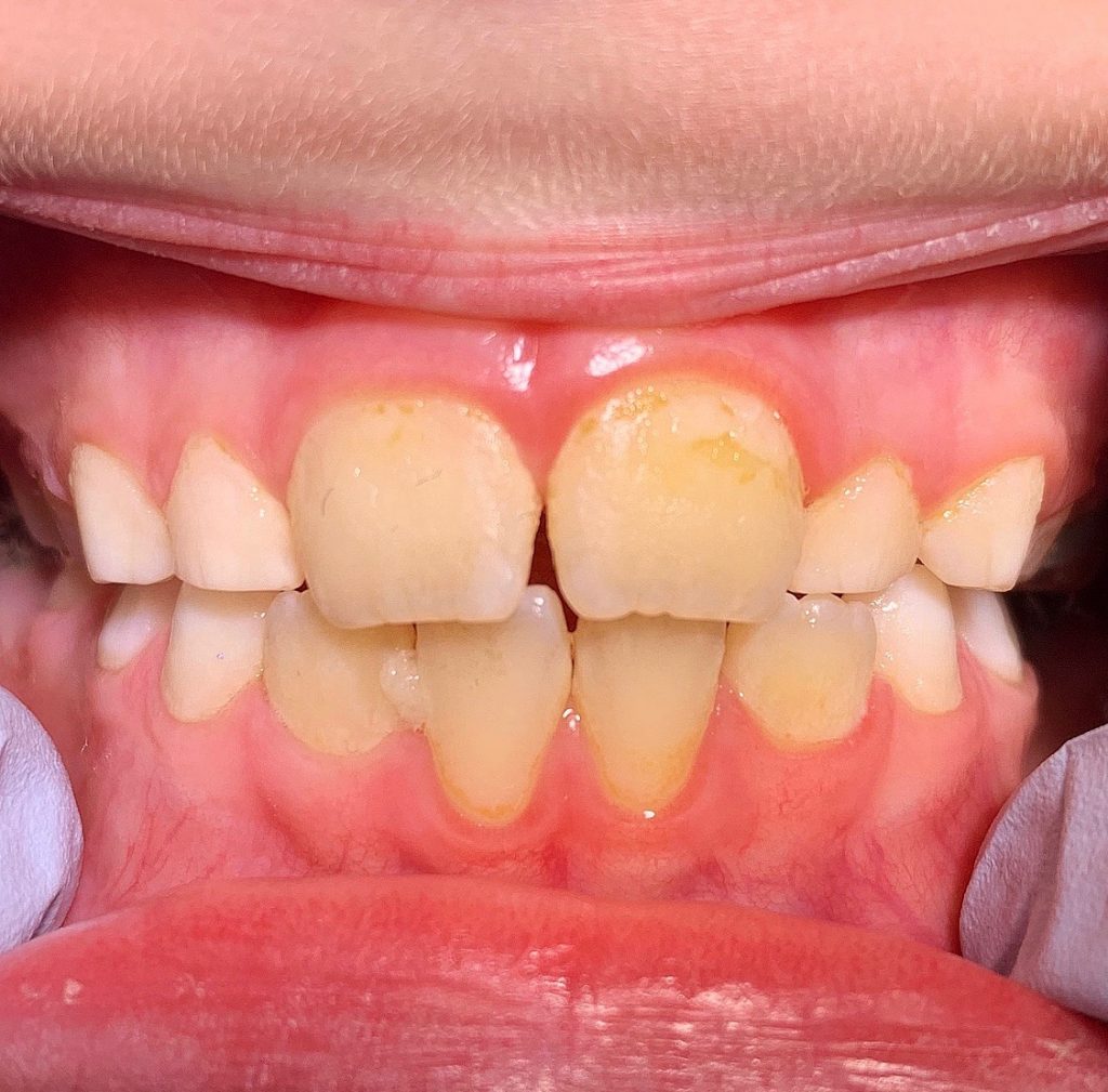 Helping children brush better: Use of disclosing solution