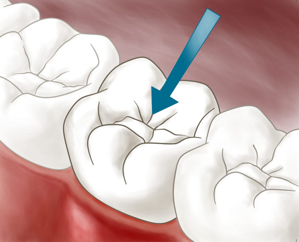 What are fissure sealants? - Norwest Paediatric Dentistry